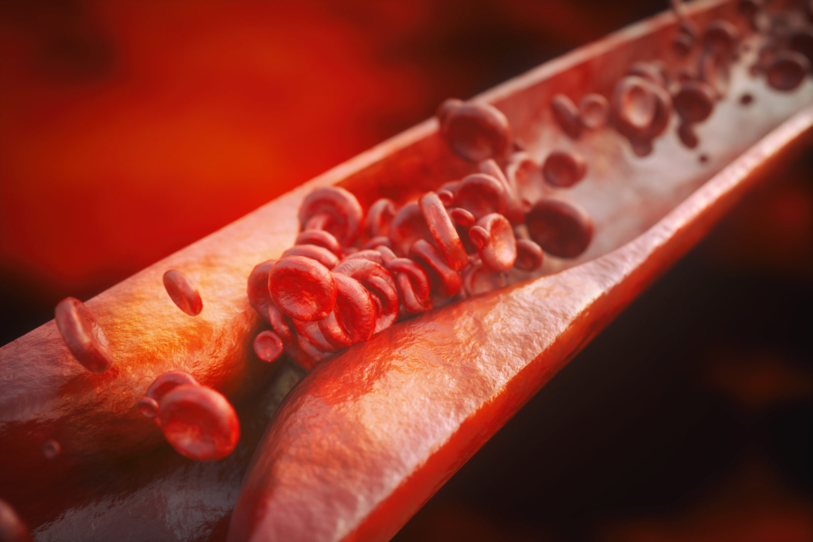 PAD Symptoms, know the signs of peripheral artery disease